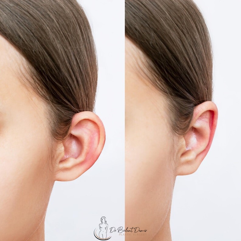 otoplasty antalya,turkey-ear pinning,prominent ear surgery cost